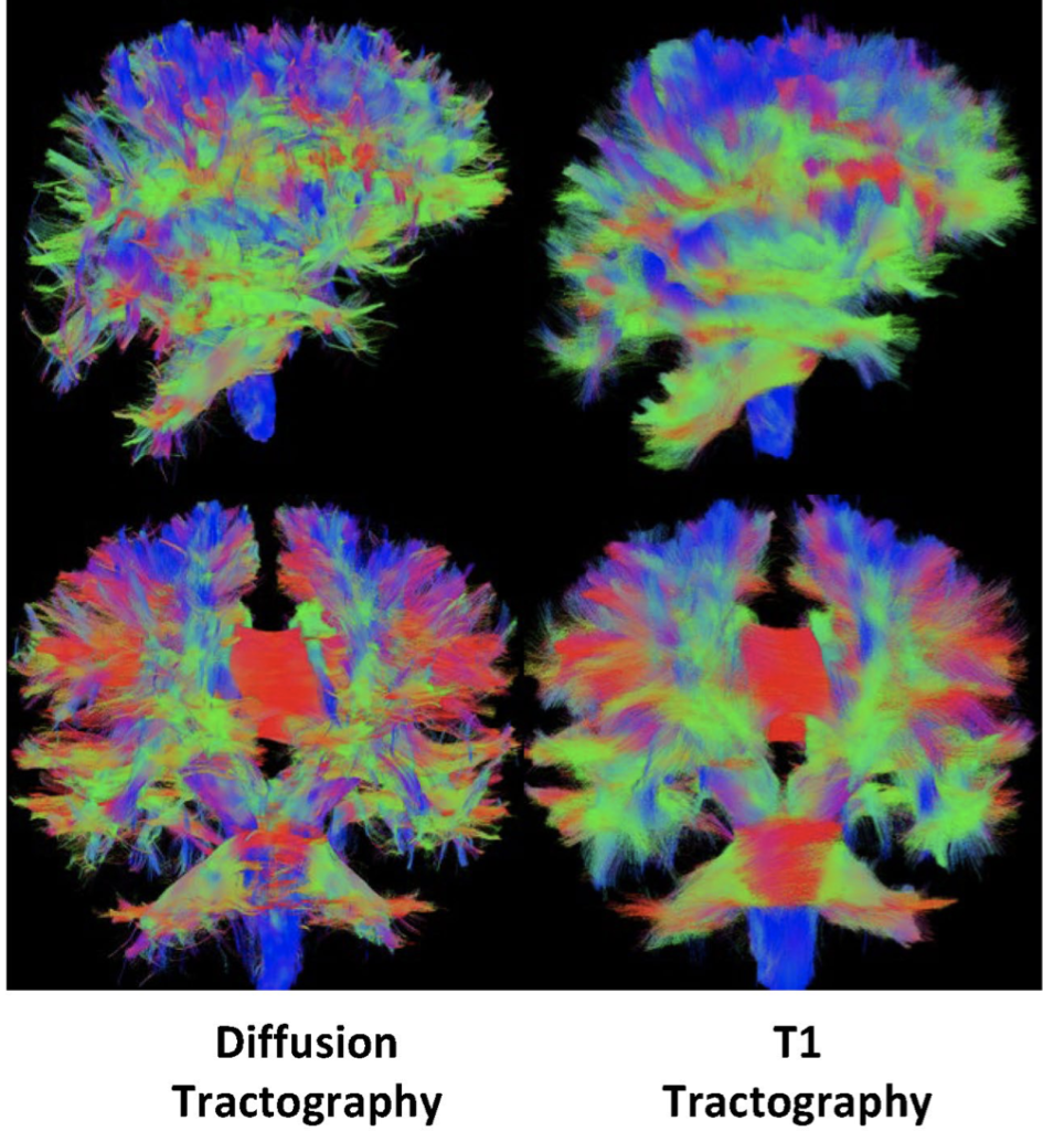 Tractography with T1-weighted MRI and associated anatomical constraints on clinical quality ...